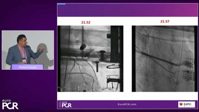 Tailored support for complex PCI and AMI with percutaneous mechanical ...