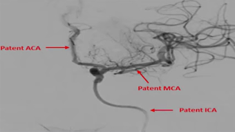 TAVI (Transcatheter aortic valve implantation)