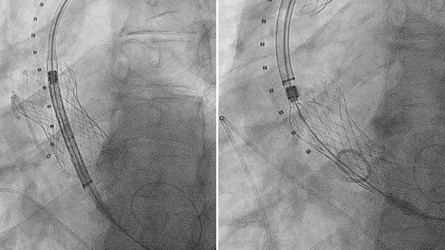 TAVI complications: Session 2