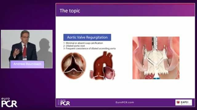 TAVI for aortic regurgitation - Addressing an unmet need with the ...