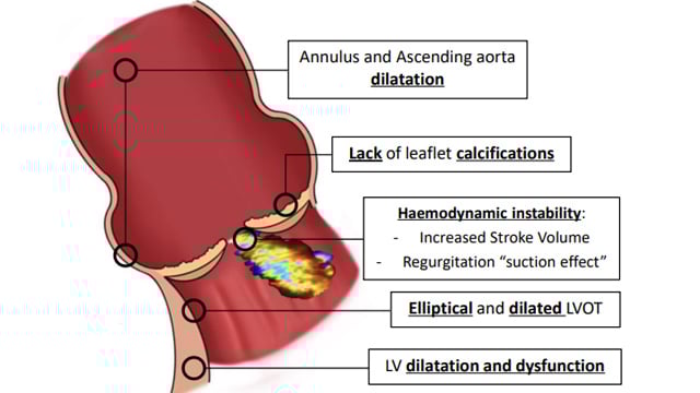 TAVI: Late-Breaking Trials and Innovations