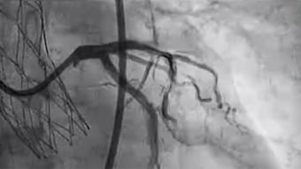 TAVI (Transcatheter aortic valve implantation)