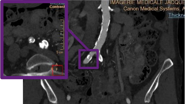 TAVI step by step: from femoral puncture to procedural success