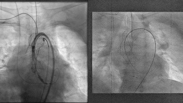TAVI: technical considerations
