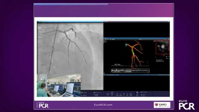 Towards a personalised coronary intervention with CT-guided robotic ...