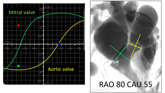 TAVI in complex situations - LIVE case
