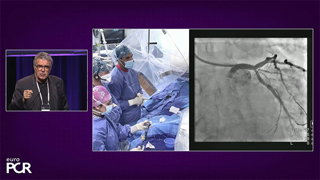 Transradial approach, from complex PCI to peripheral intervention