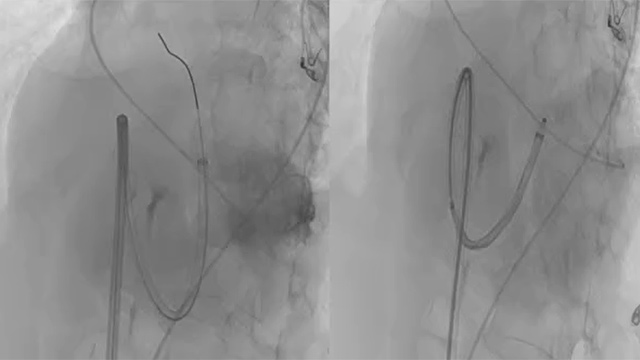 Treating ASD and VSD in heart failure patients