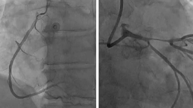 Treatment of atherosclerotic vasospastic plaque in proximal left ...