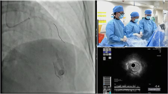 Ultra-low contrast PCI - Session with LIVE case
