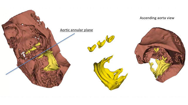 Valve-in-valve TAVI: session 1