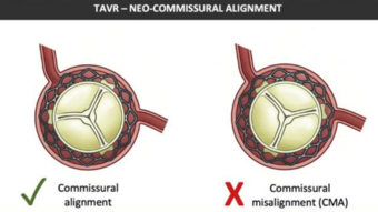 TAVI (Transcatheter aortic valve implantation)