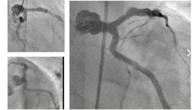 Calcification clinical cases