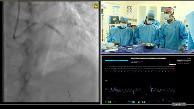 Calcified bifurcation lesion - LIVE case