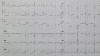 ST-segment elevation myocardial infarction (STEMI)