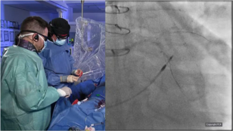 CTO (Chronic total occlusion)