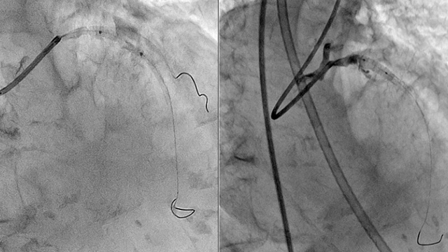 How to manage complications in CTO PCI