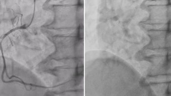 ST-segment elevation myocardial infarction (STEMI)