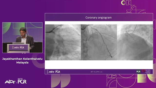 Leave nothing behind: DCB-only PCI strategy - How DCB evidence has ...
