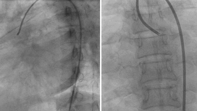 Left main interventions: cutting-edge insights