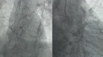 Stable CAD (Coronary artery disease)