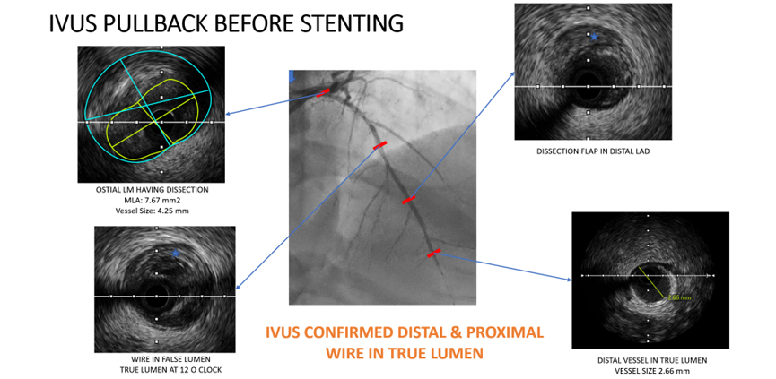 Strategies for unexpected stable CAD complications