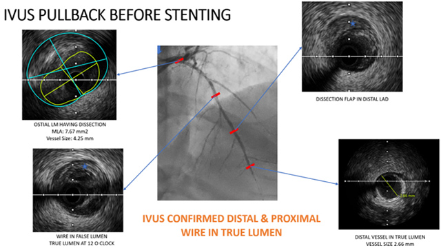 Strategies for unexpected stable CAD complications
