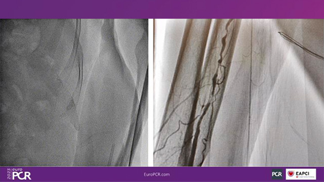 Addressing vessel perforation in interventional cardiology