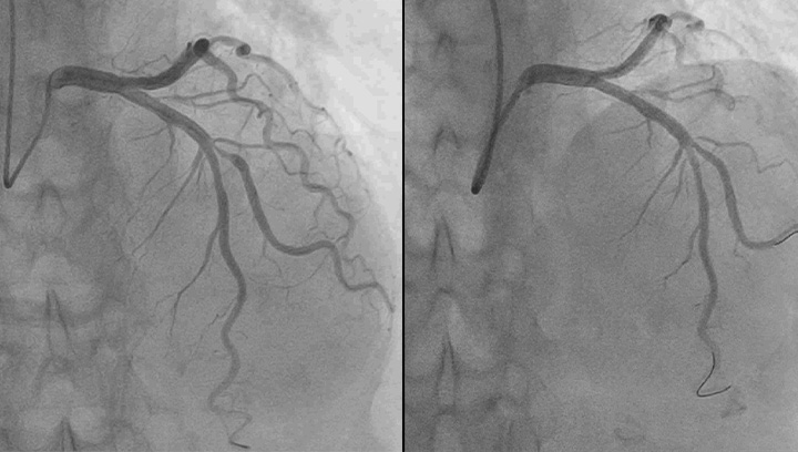 Bifurcation PCI with provisional technique