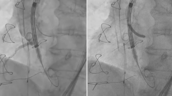 TAVI (Transcatheter aortic valve implantation)