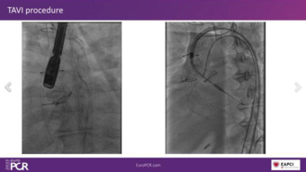 TAVI (Transcatheter aortic valve implantation)