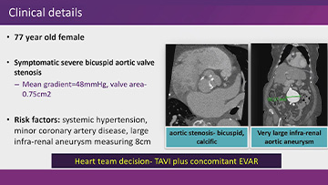 Complex vascular access for TAVI procedure