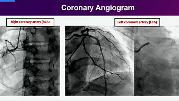 Complications in left main PCI