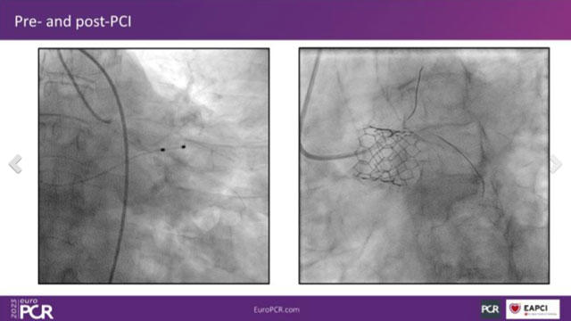 Coronary access and PCI after TAVI