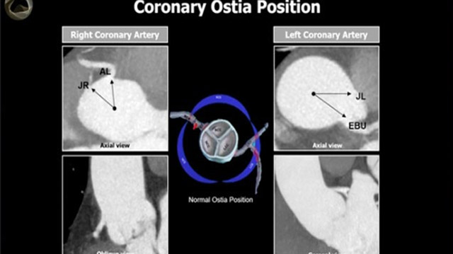 Coronary CT reading