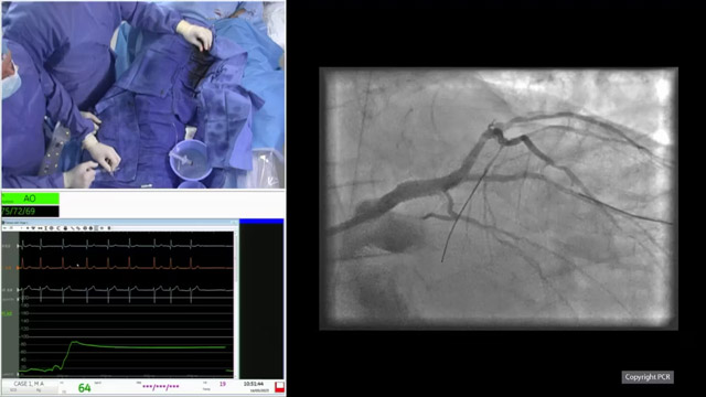 Distal left main stenosis with a trifurcation - LIVE case