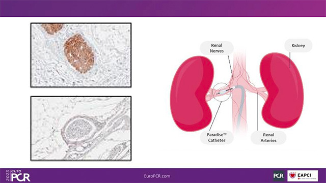 Get ready – how to set up a successful renal denervation programme
