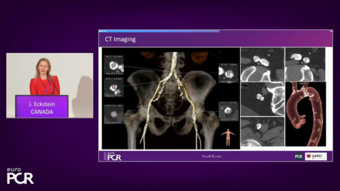 TAVI (Transcatheter aortic valve implantation)