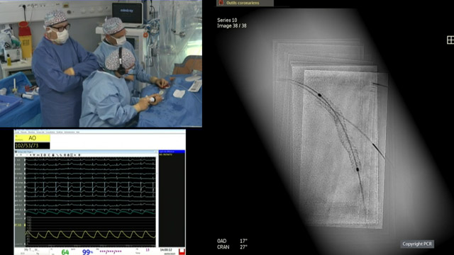 Left main and complex bifurcation stenting