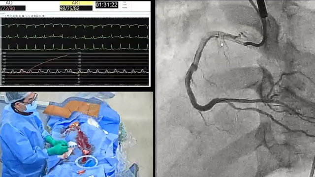 Left main interventions in the context of cardiogenic shock