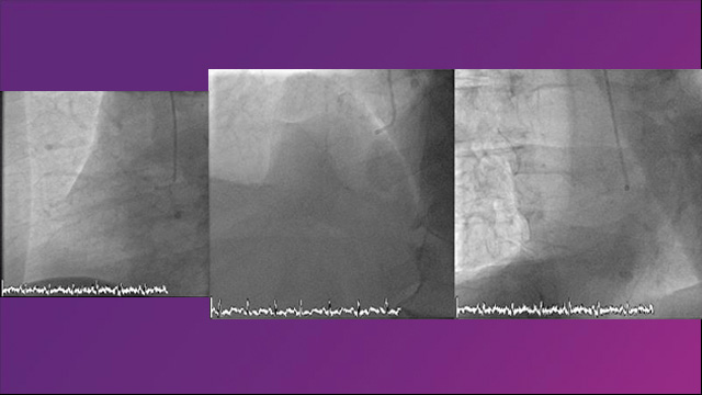 Managing high-bleeding risk in case examples