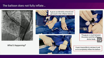 TAVI (Transcatheter aortic valve implantation)