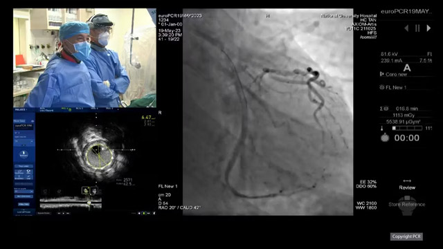 Multivessel disease PCI guided by physiology and intracoronary imaging ...
