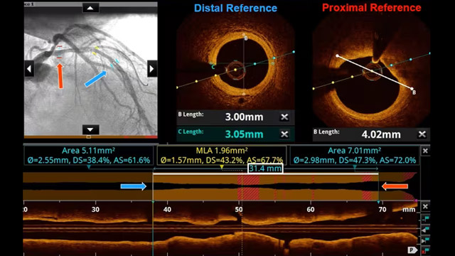 My patient with complex angiogram