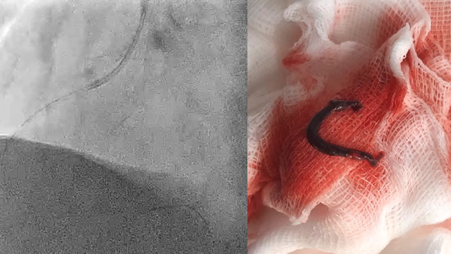 My patient with STEMI