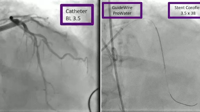 PCI complications: stent loss / dissertations / perforations