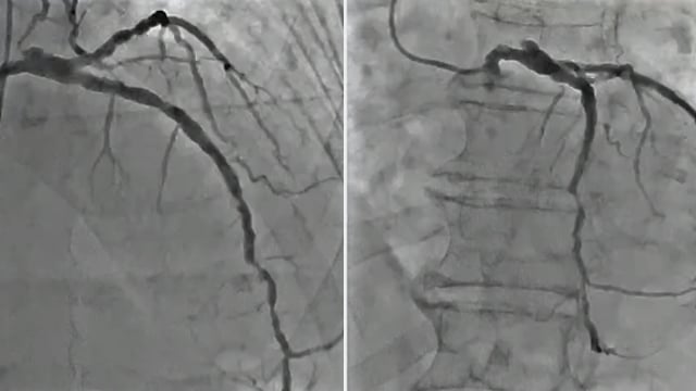 PCI for complex coronary lesions