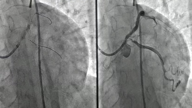 Pitfalls during primary PCI in STEMI patients and TAVI procedure