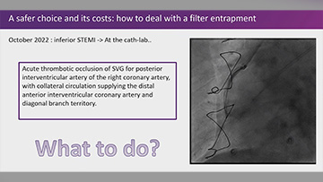 Primary PCI in challenging STEMI