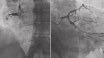 NSTEMI (Non-ST-segment elevation myocardial infarction)